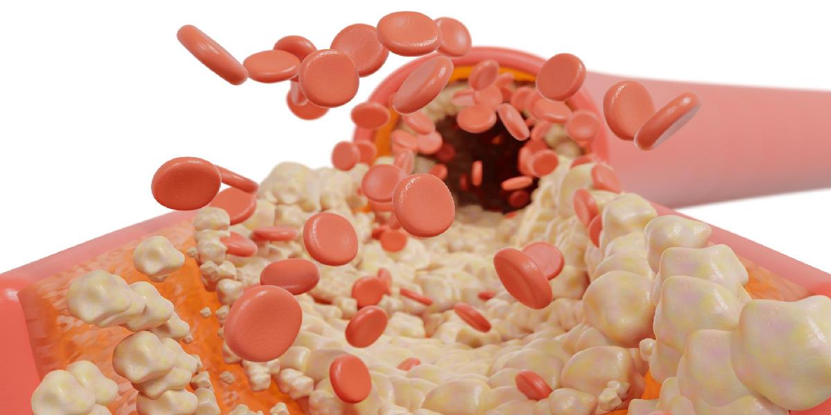 Hengrui Pharmaceuticals' phase III trial shows highly selective URAT1 ...