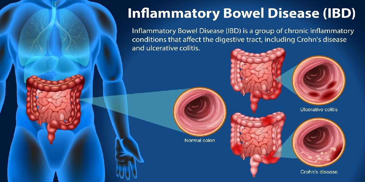Everest Medicines reports phase 3 trial of VELSIPITY achieves ...